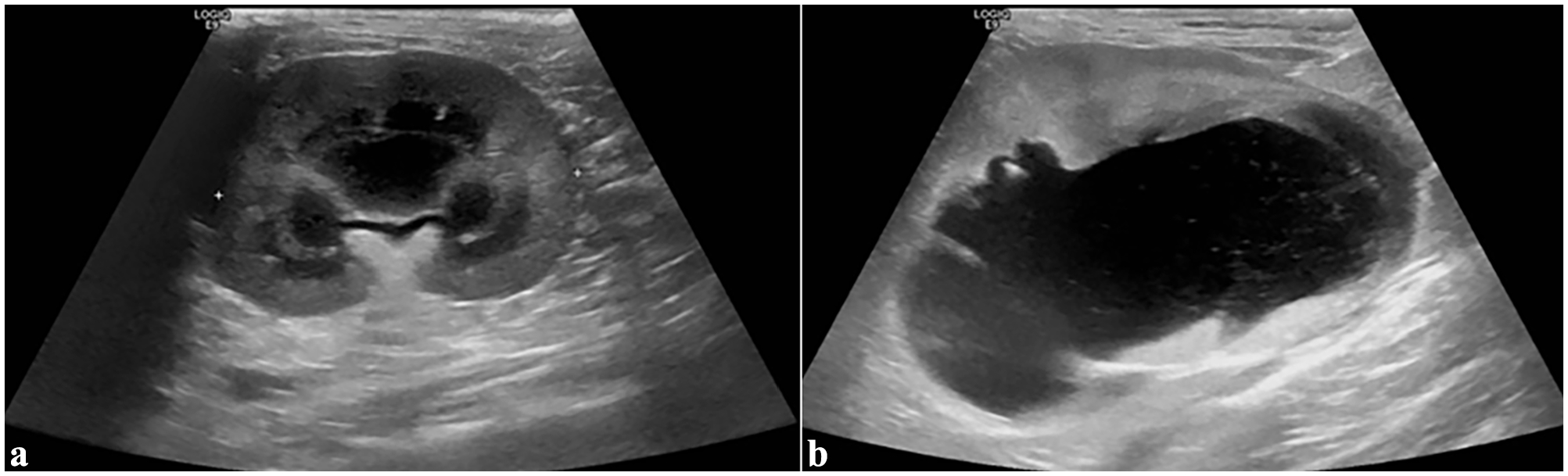 Subcutaneous ureteral bypass for treatment of proximal ureteral ...