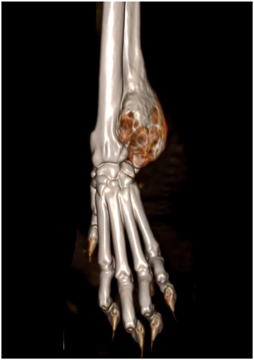 Distal partial ulnectomy with ulnar styloid process excision for ...