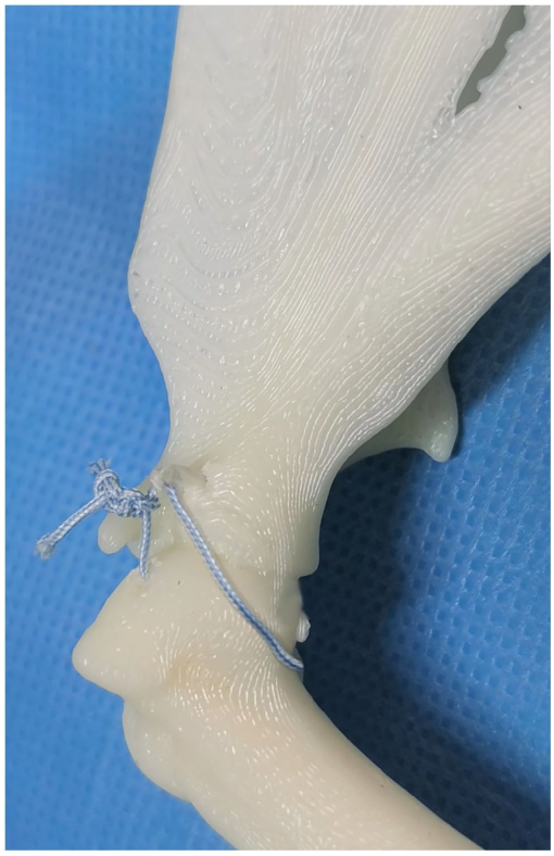 Novel prosthetic ligament repair of a shoulder luxation in a cat using ...